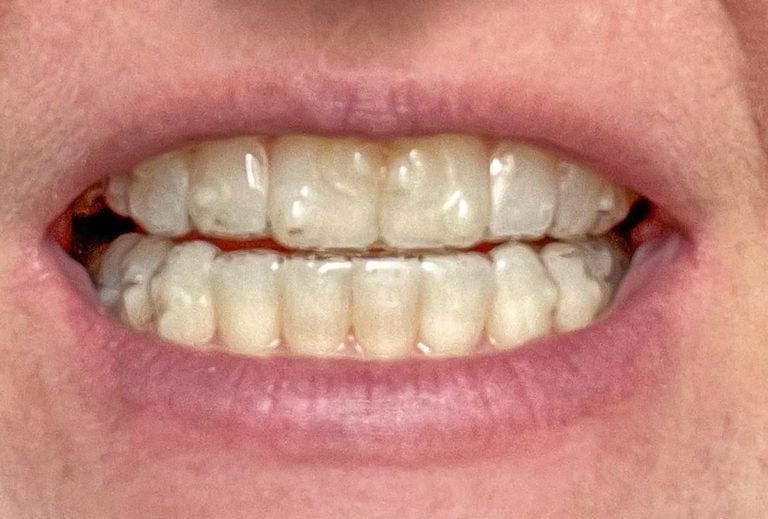 14 Week Invisalign Results 28 Week Invisalign Results