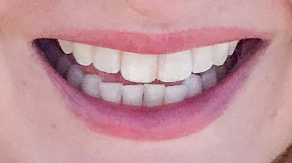 14 Week Invisalign Results 28 Week Invisalign Results